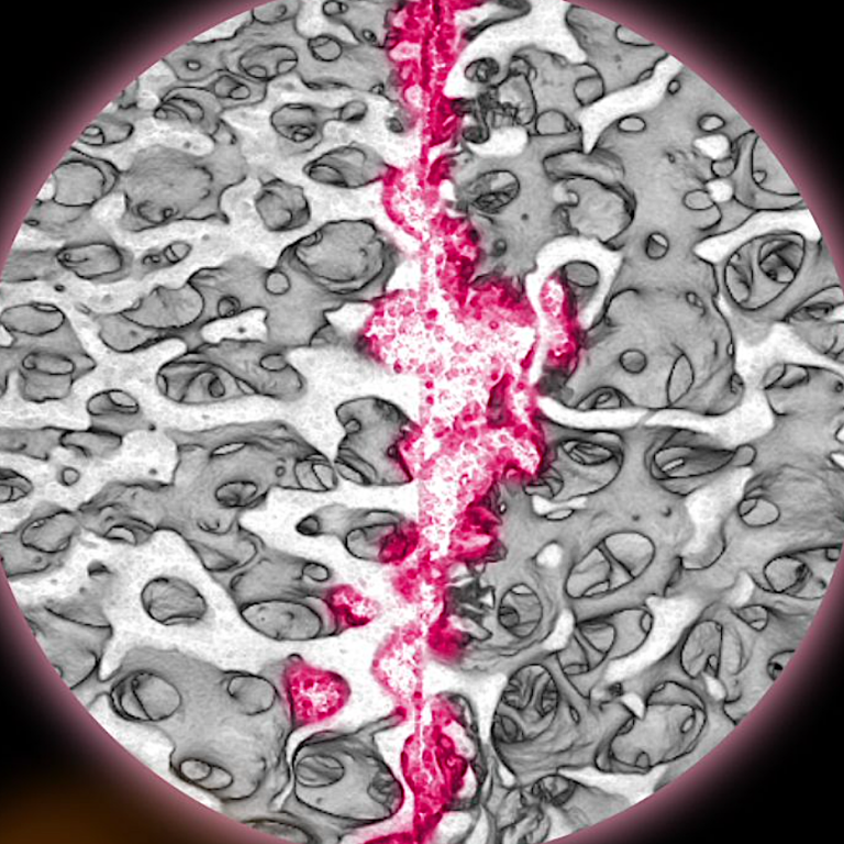 REVBIO TETRANITE IS A NOVEL REGENERATIVE ADHESIVE BIOMATERIAL